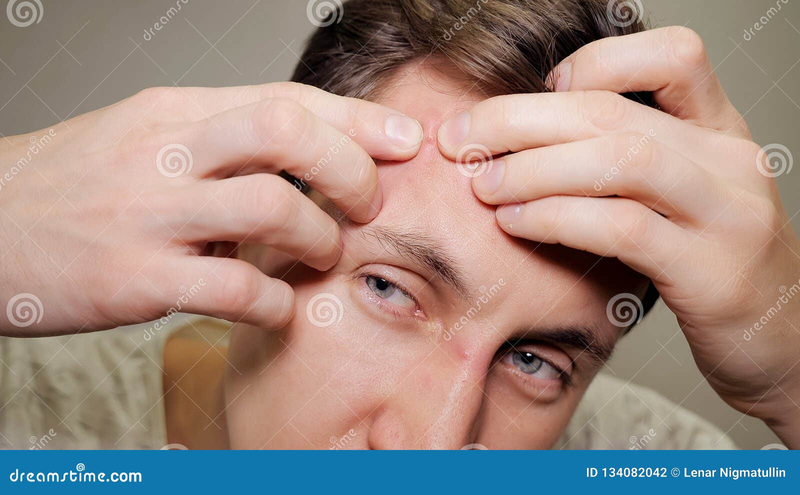 Young Man Squeezing a Pimple Stock Photo - Image of adult, beauty ...