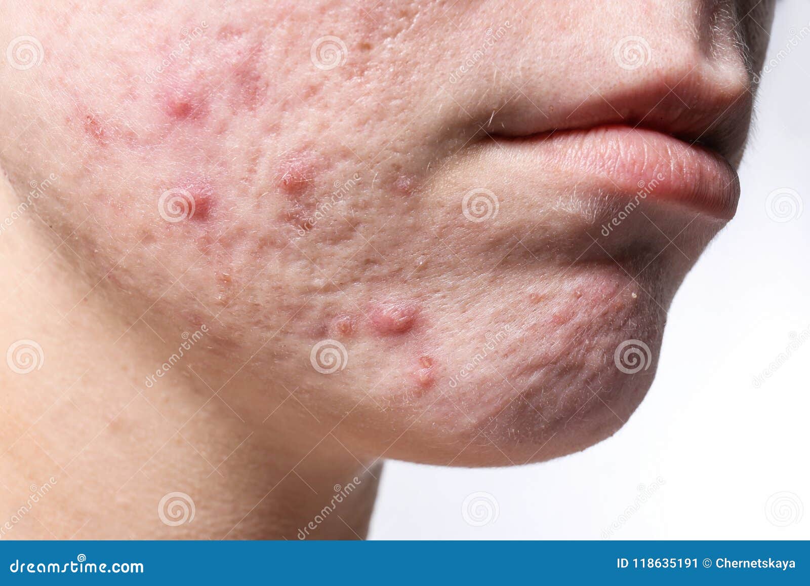 Acne Face Stock Photos - Royalty Free Images