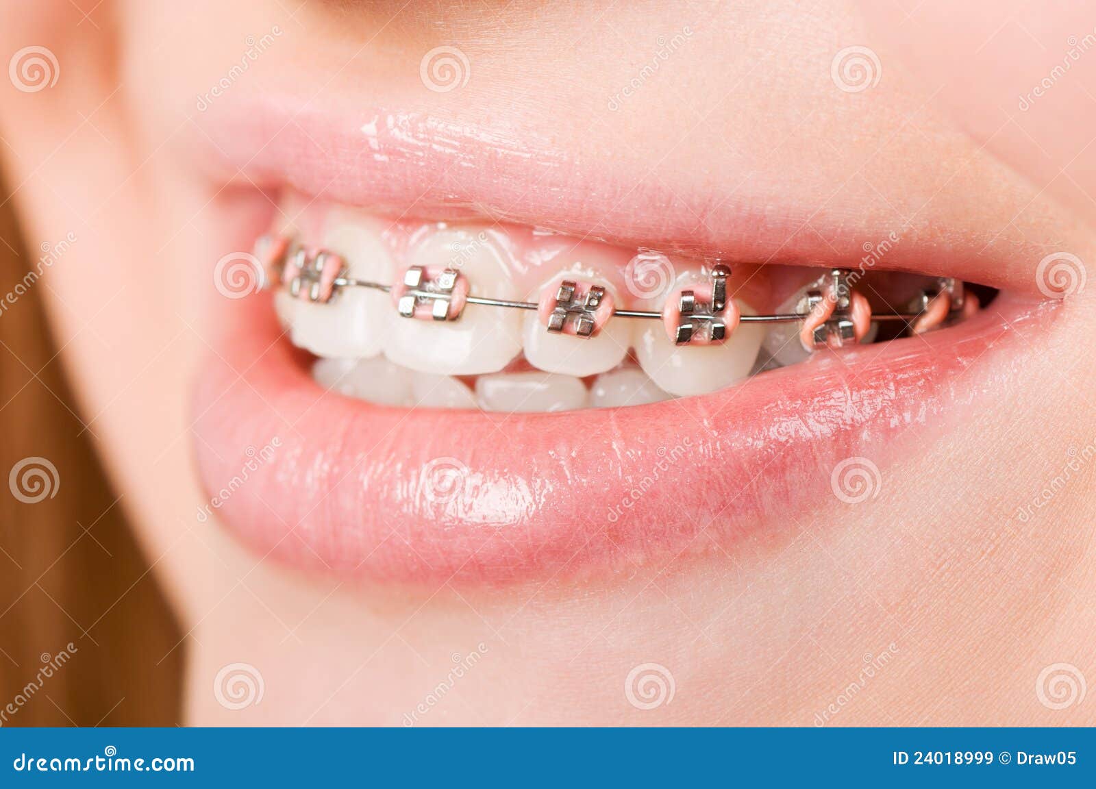 Young Woman with Brackets on Teeth Stock Image - Image of dental, lips ...