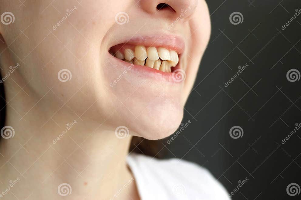Young Woman with Curve Row and Wrong Bite. Stock Photo - Image of ...