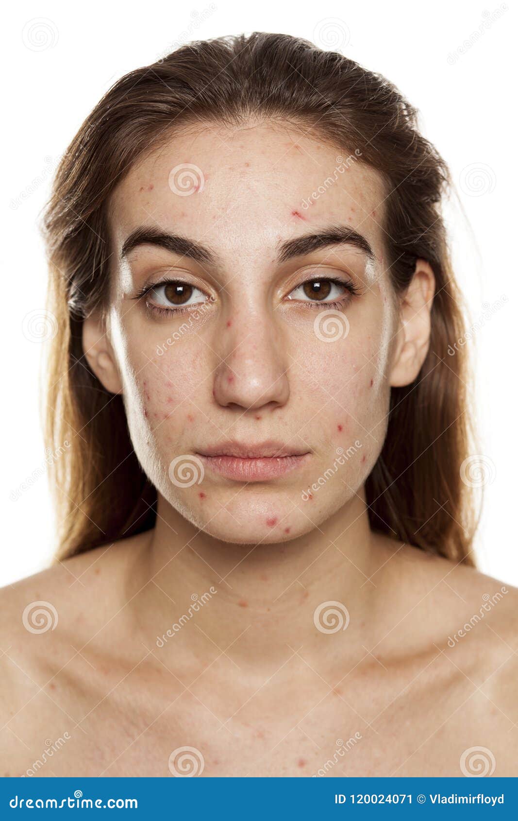 Problematic skin stock image. Image of care, adolescence - 120024071