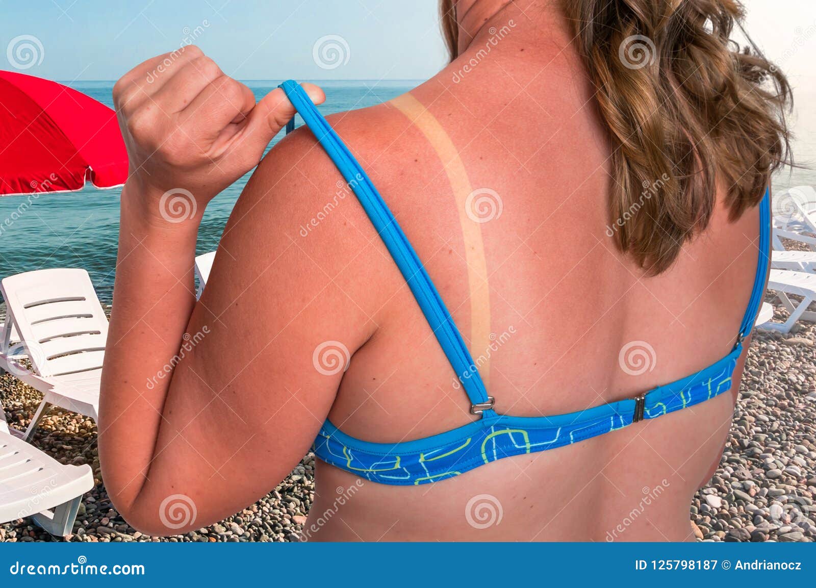 Sunburn Concept Young Woman With Red Sunburned Skin On Her Back
