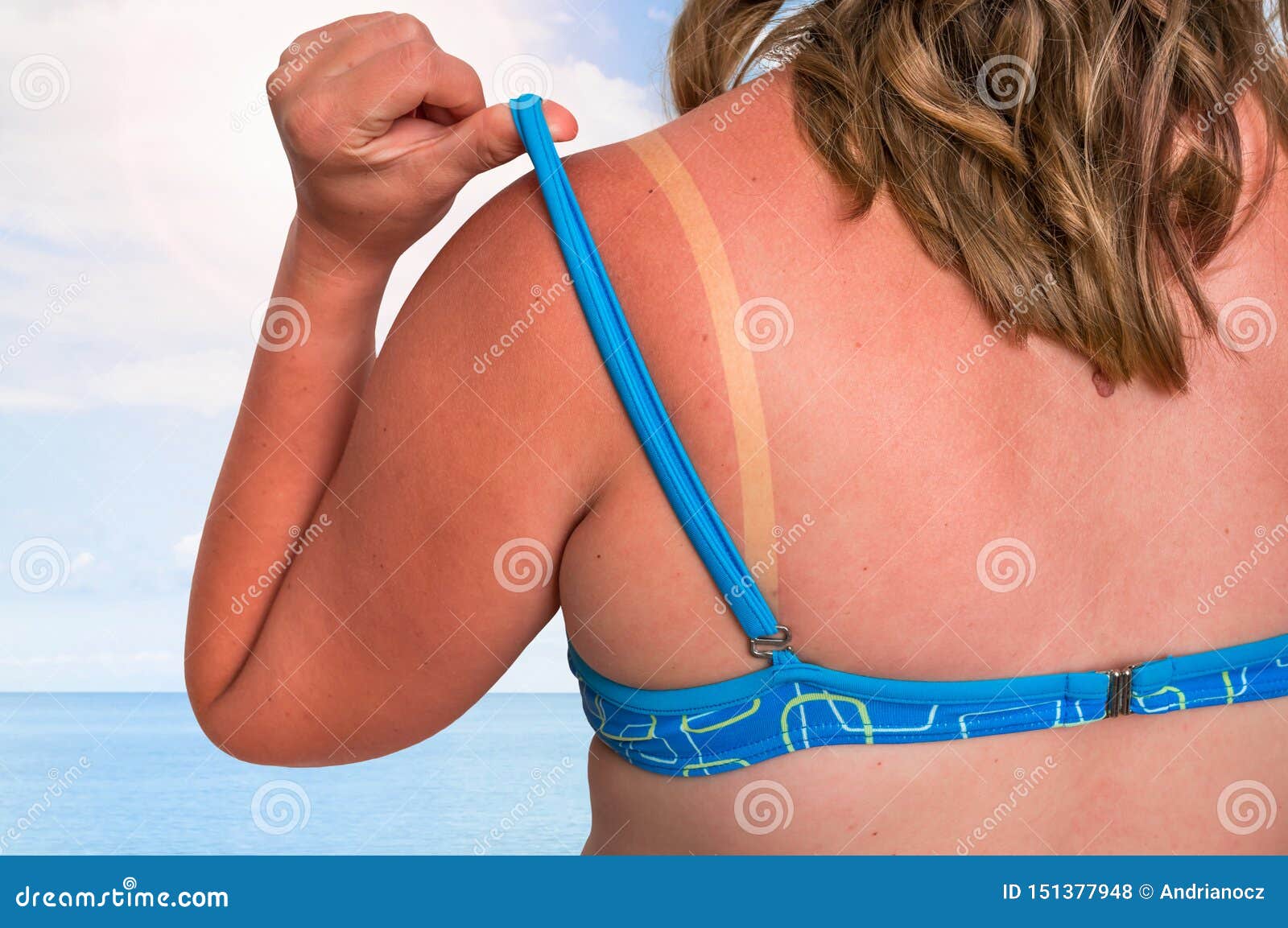 Sunburn Concept Young Woman With Red Sunburned Skin On Her Back