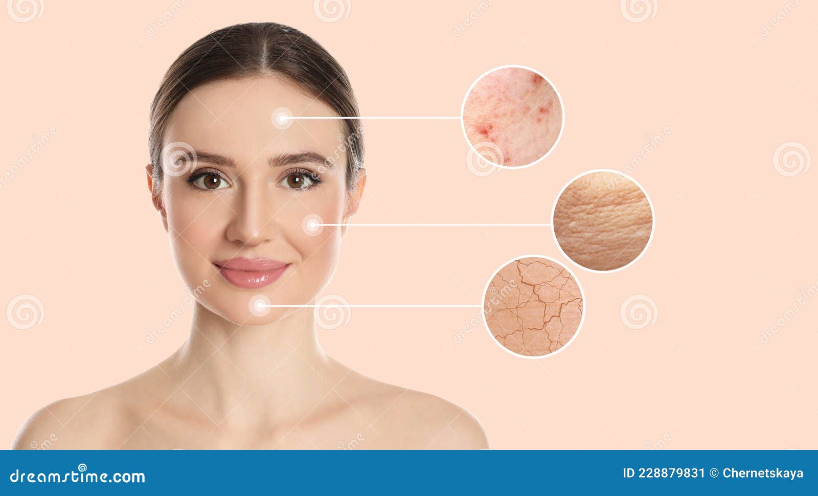 Young Woman with Skin Problem on Beige Background Stock Image - Image ...