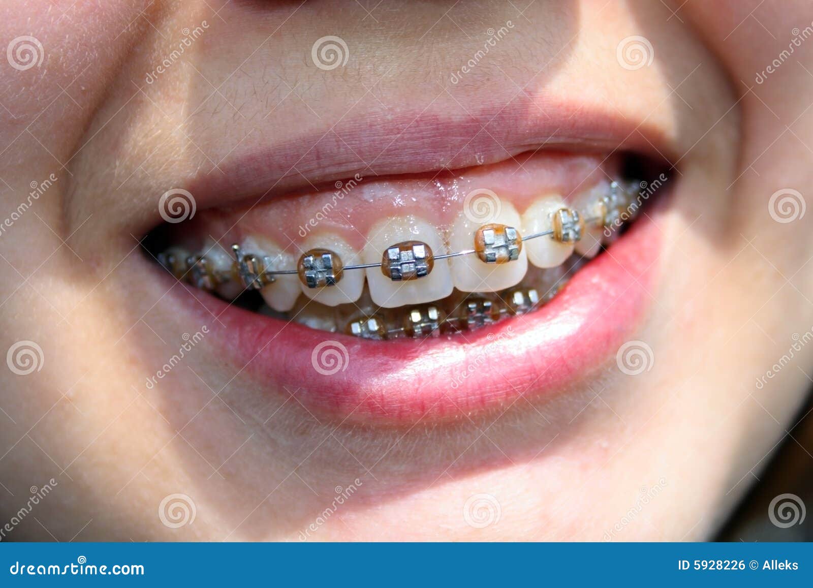 Young Woman Smile with Bracket Stock Photo - Image of repair, face: 5928226