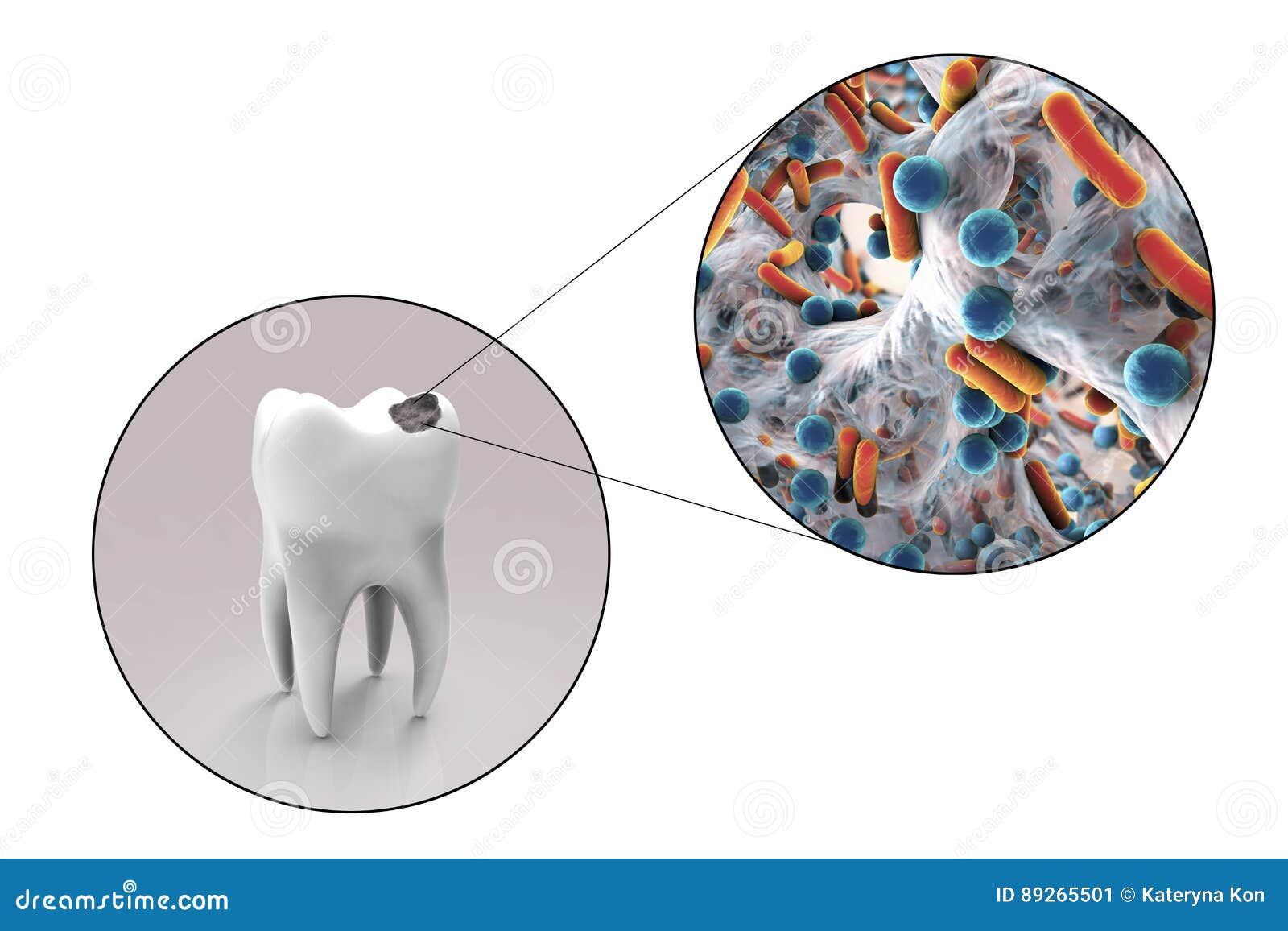 Zahn Mit Zahnmedizinischer Karies Stock Abbildung - Illustration von ...
