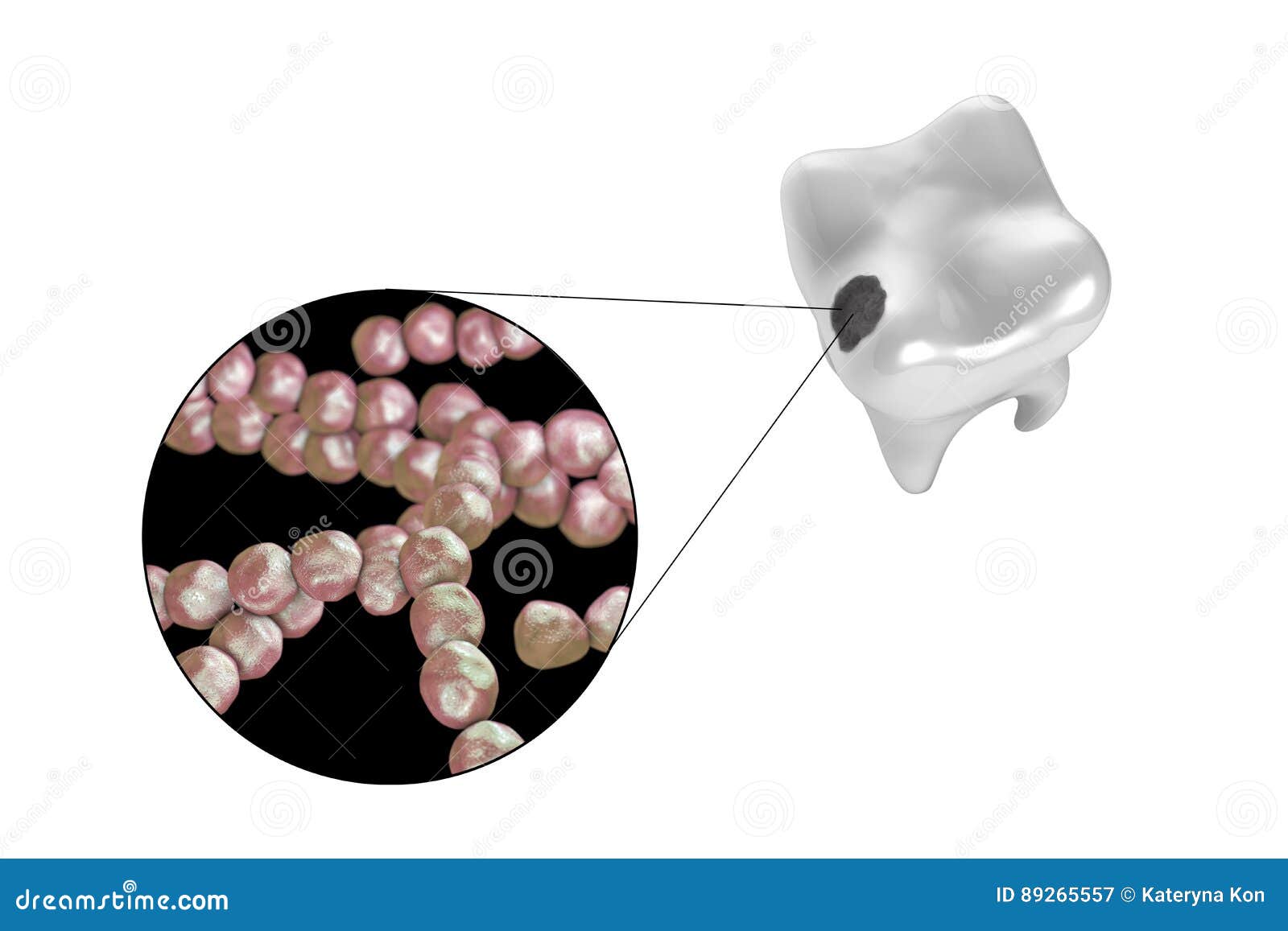 Zahn Mit Zahnmedizinischer Karies Stock Abbildung - Illustration von ...
