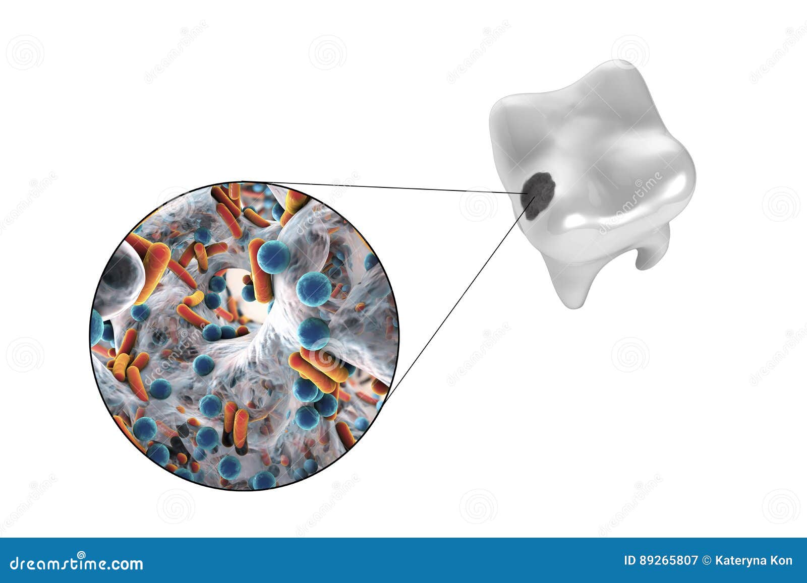 Zahn Mit Zahnmedizinischer Karies Stock Abbildung - Illustration von ...