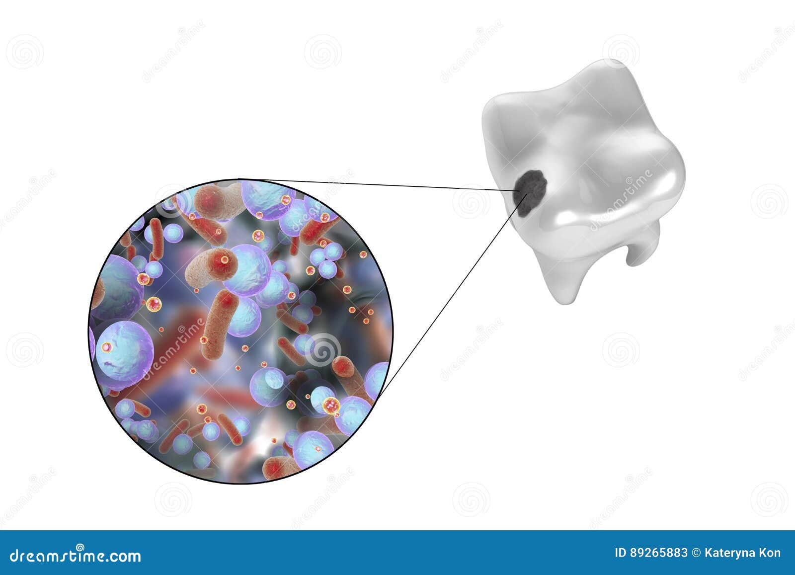 Zahn Mit Zahnmedizinischer Karies Stock Abbildung - Illustration von ...