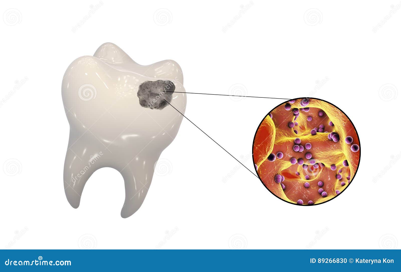 Zahn Mit Zahnmedizinischer Karies Stock Abbildung - Illustration von ...