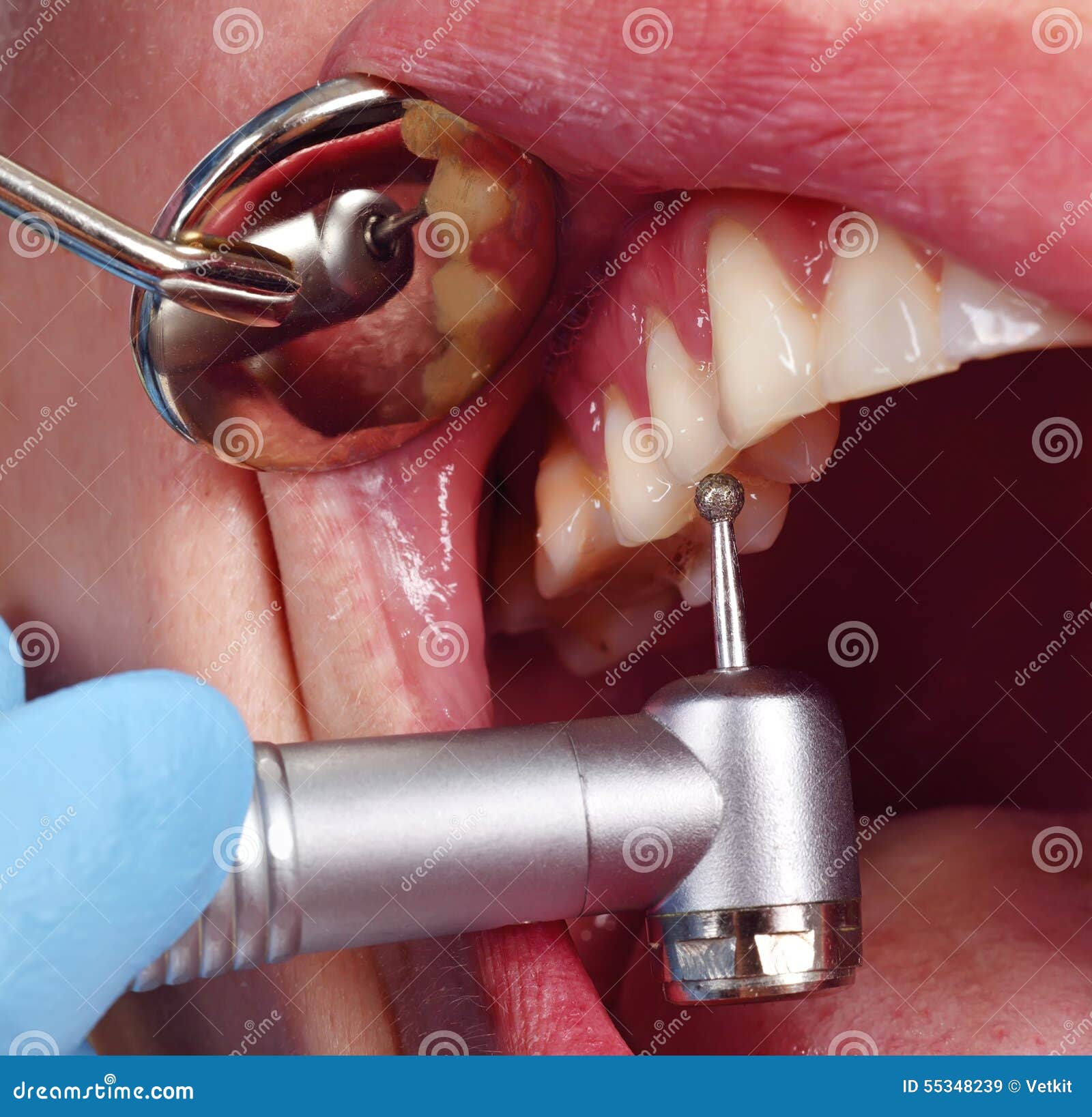 Zahnarzt, Der Zahnbohrer Verwendet Stockbild - Bild von komplett ...