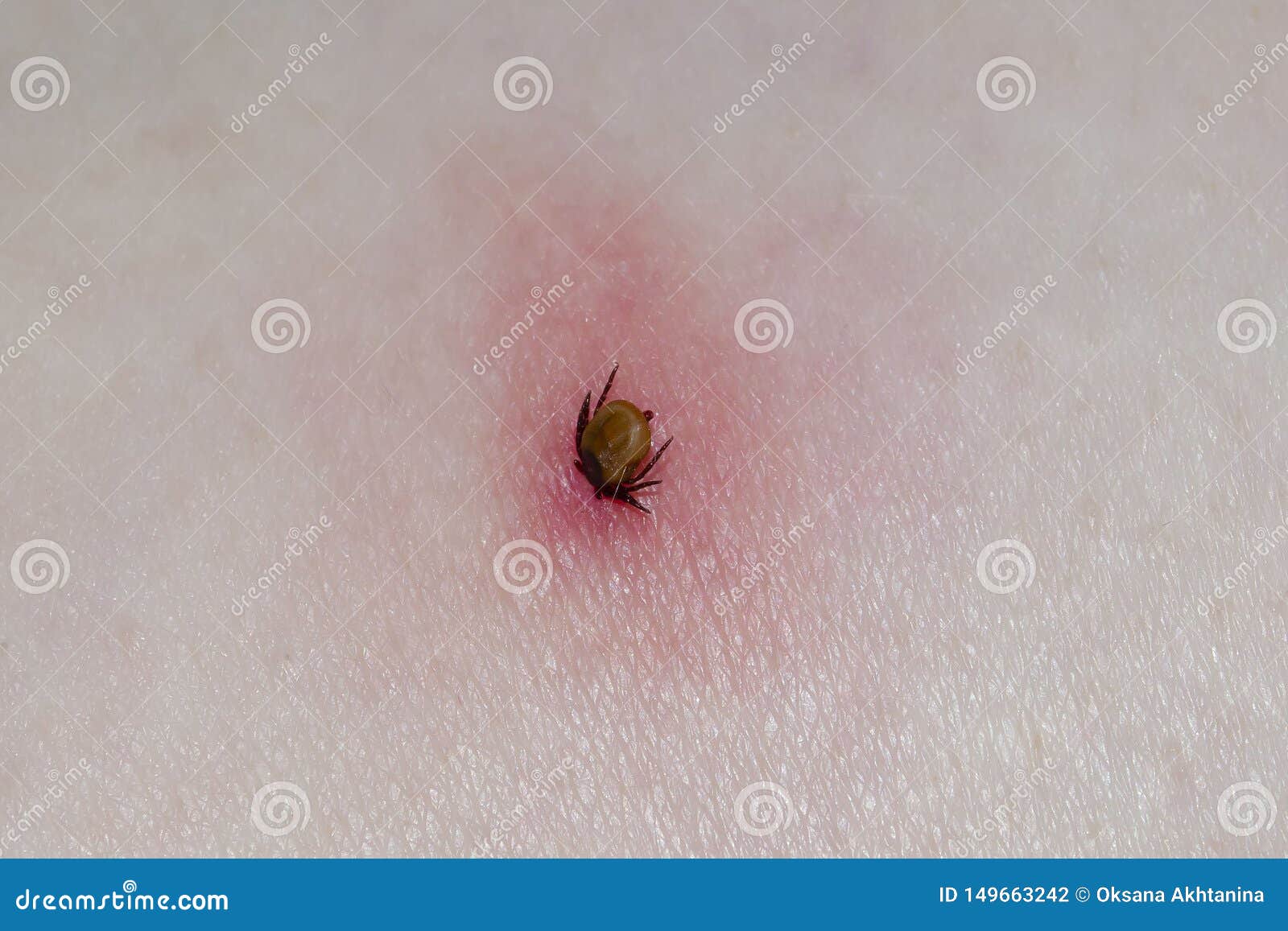 Zecke Mit Seinem Kopf, Der in Der Menschlichen Haut Haftet Stockfoto ... Zecke Mit Seinem Kopf, Der in Der Menschlichen Haut Haftet Stockfoto ...