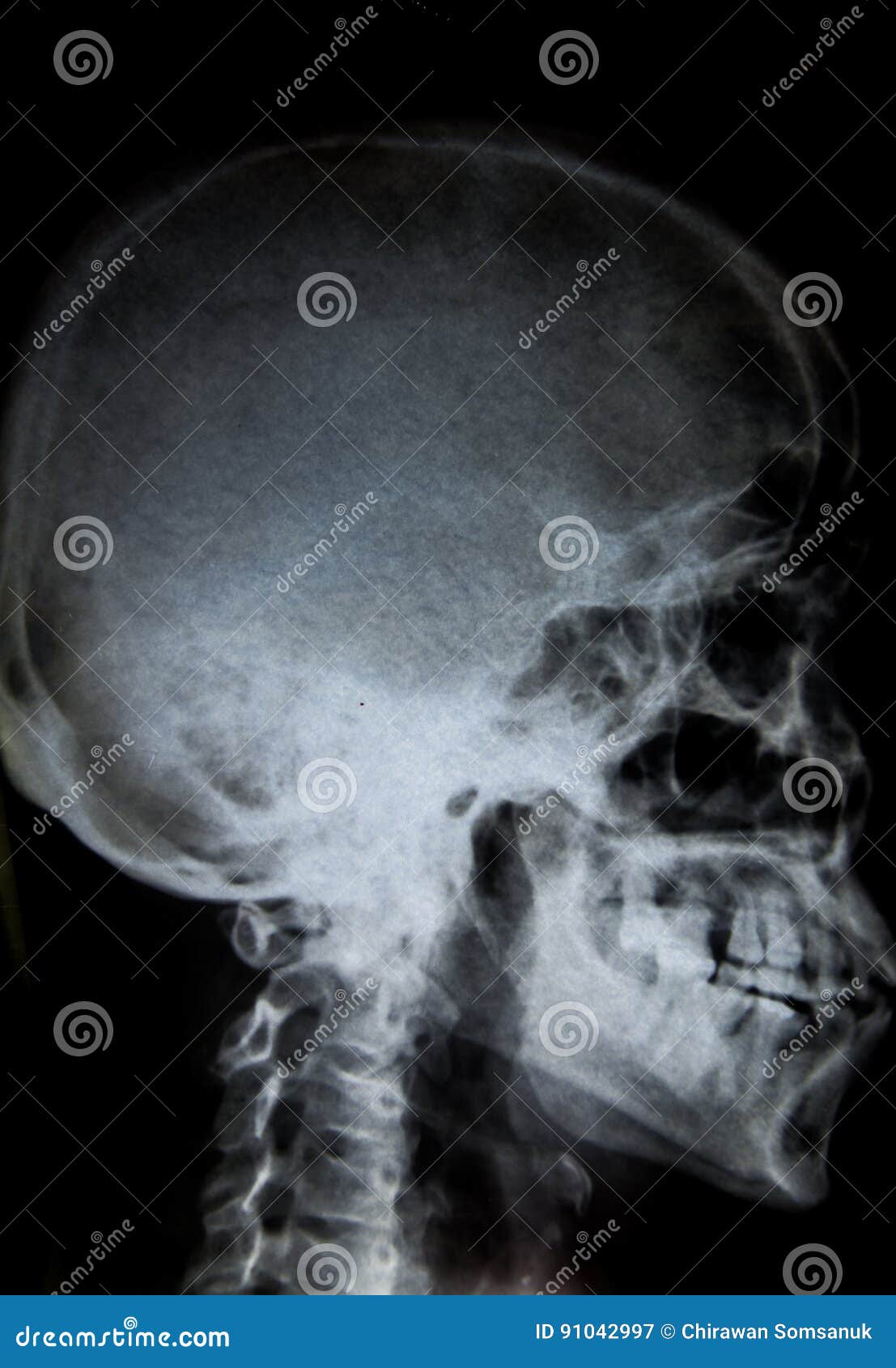 Zijde Van De Film X-ray Schedel Stock Afbeelding - Image of gezicht ...