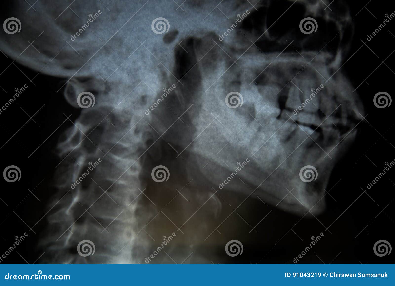Zijde Van De Film X-ray Schedel Stock Afbeelding - Image of been ...