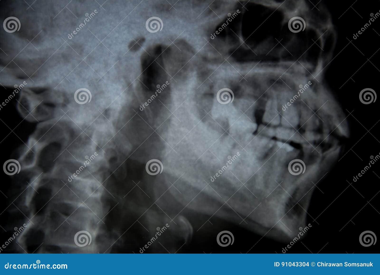 Zijde Van De Film X-ray Schedel Stock Foto - Image of been, anatomie ...