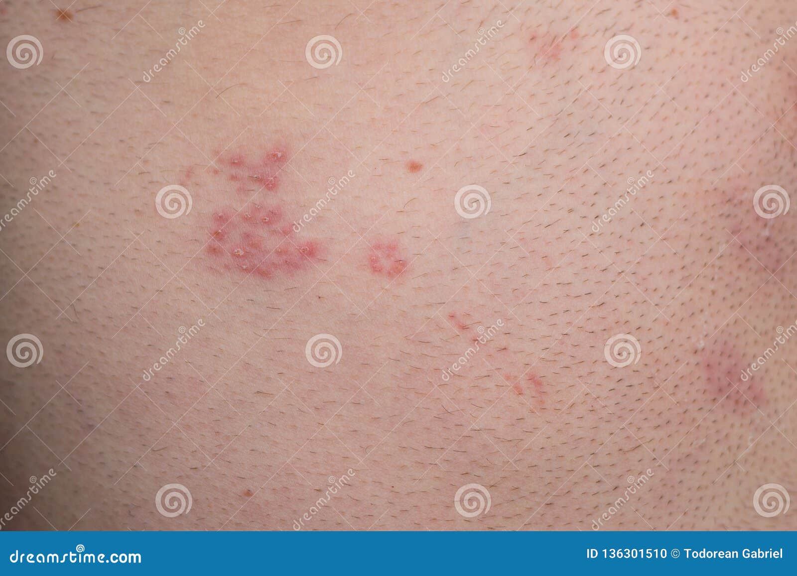 Zona, Une Maladie Douloureuse Photo stock - Image du ruches, éruption ...