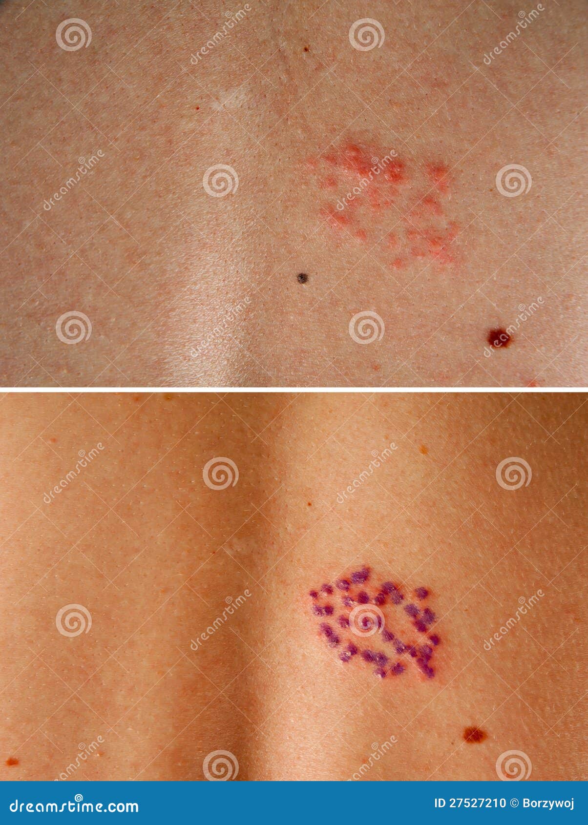 Zoster rash stock photo. Image of rash, symptoms, medical - 27527210