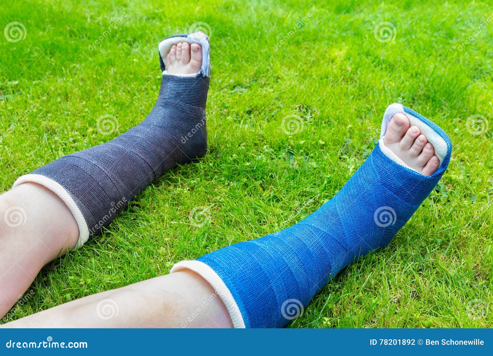 Zwei Gipsbeine Junge Auf Gras Stockfoto - Bild von glück, schwarzes ...