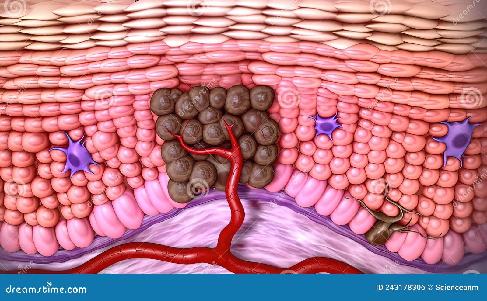 3 ª Ilustración Médica Del Cáncer De Piel Carcinoma De Células