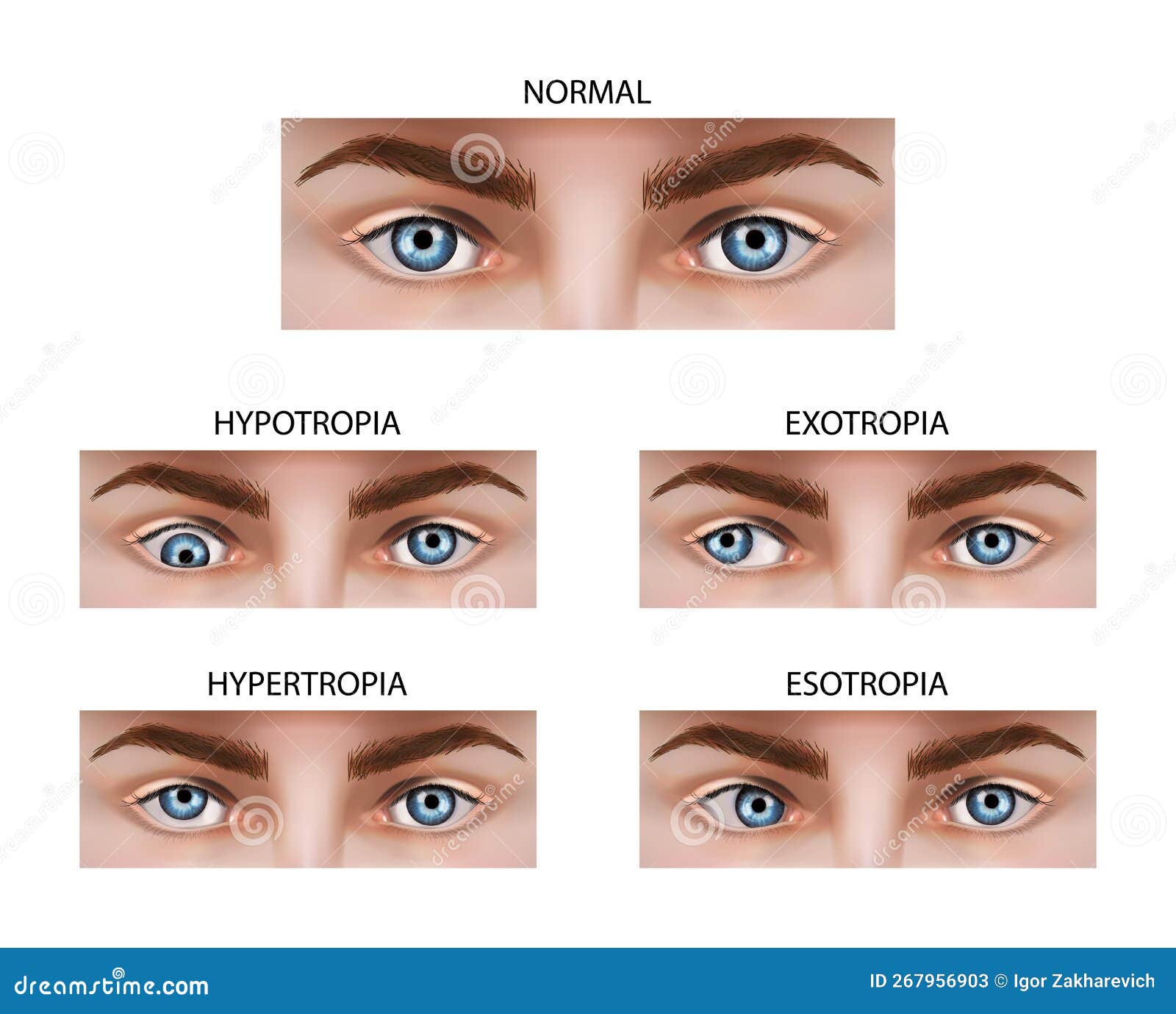 Different Types of Strabismus. Stock Illustration - Illustration of disease, disorder: 267956903